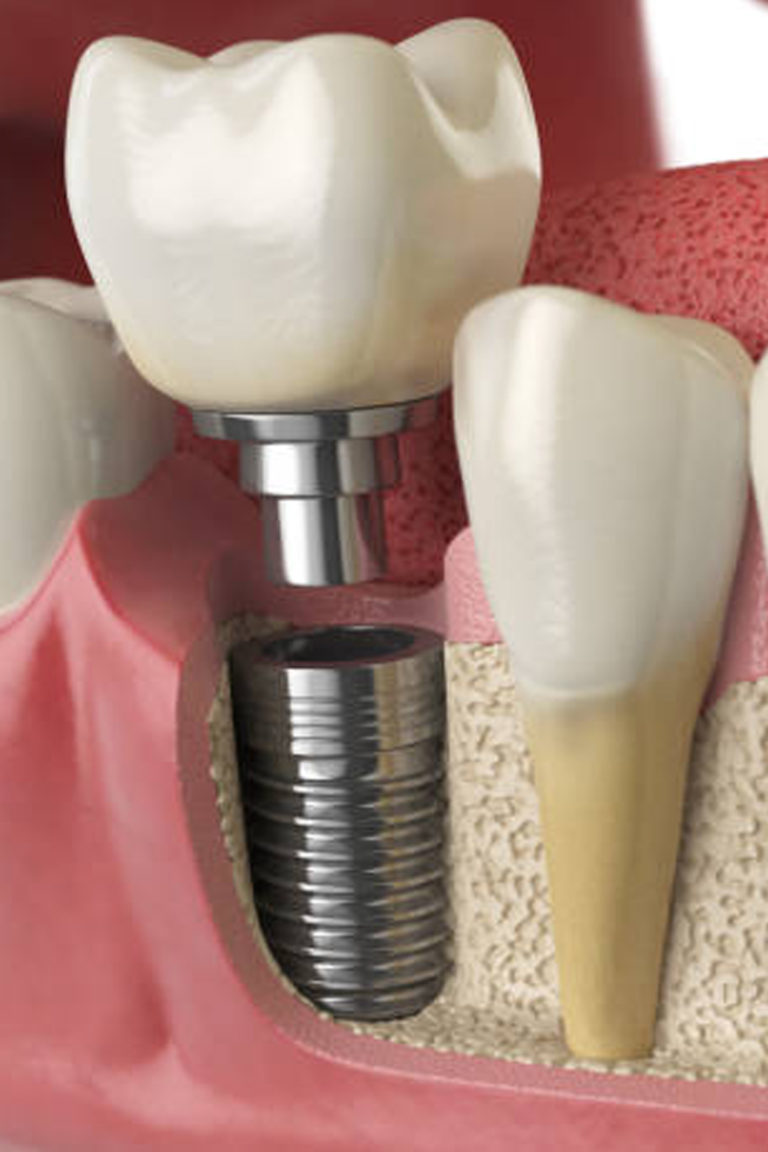 ΕΜΦΥΤΕΥΜΑΤΑ ΔΟΝΤΙΩΝ – Dental Care Ioannina